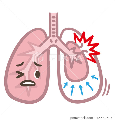 Pneumothorax disease - Stock Illustration [65589607] - PIXTA