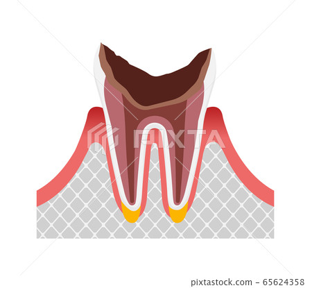 Illustration of caries progression and symptoms... - Stock Illustration ...