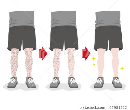 Shin hair removal - Stock Illustration [65981322] - PIXTA