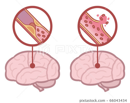Cerebral infarction cerebral hemorrhage - Stock Illustration [66043434 ...