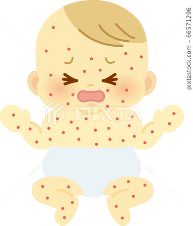 Baby in a diaper with a rash on her whole body... - Stock Illustration ...