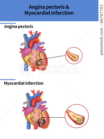 Angina myocardial infarction medical illustration - Stock Illustration ...