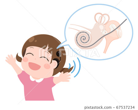 Cochlear electrode with a girl wearing a... - Stock Illustration ...