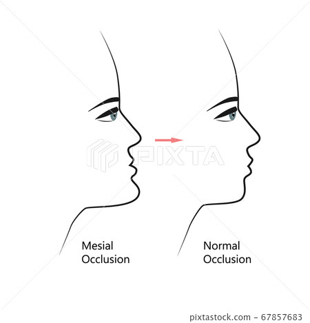 Mesial bite profile before and after... - Stock Illustration [67857683 ...