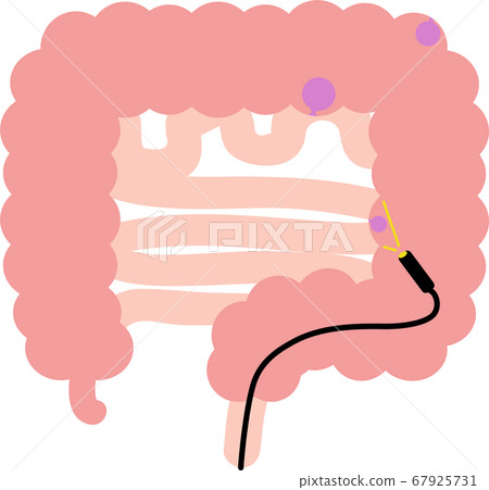 Illustration of large intestine polyp Internal... - Stock Illustration ...