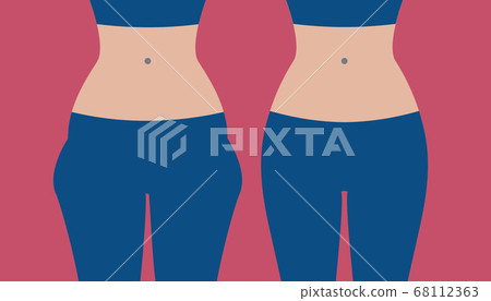 Hip liposuction, hip correction before and after - Stock Illustration ...