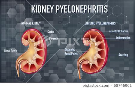 Informative illustration of Pyelonephritis - Stock Illustration ...
