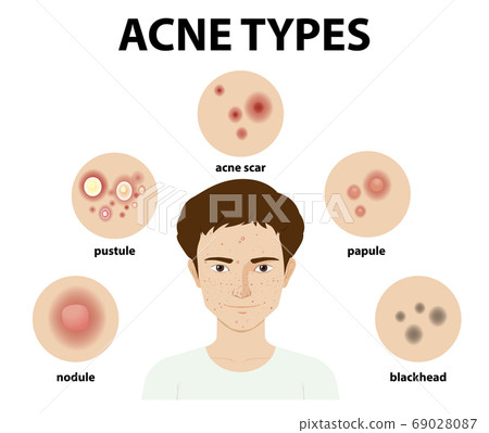 Types of acne on the skin or pimples - Stock Illustration [69028087 ...