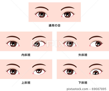 Types of squint vector illustrations (inner... - Stock Illustration ...