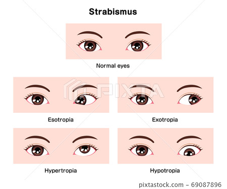 Types of strabismus Vector illustrations... - Stock Illustration ...