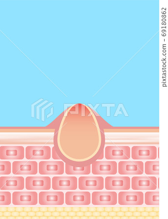 acne skin spot pimple problem vector design. - Stock Illustration ...
