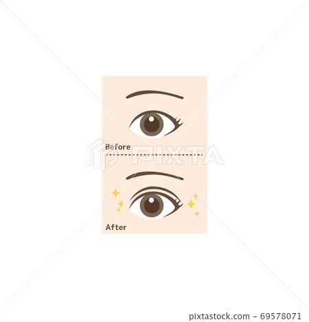 Illustration of making a single eyelid a double... - Stock Illustration ...