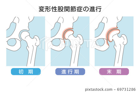 Illustration of the progression of coxarthrosis - Stock Illustration ...