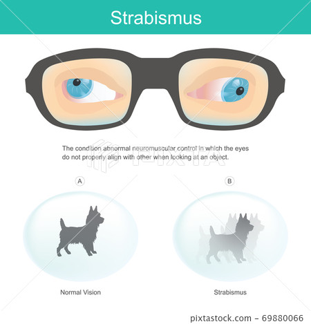 Strabismus. Meaning the condition abnormal... - Stock Illustration ...