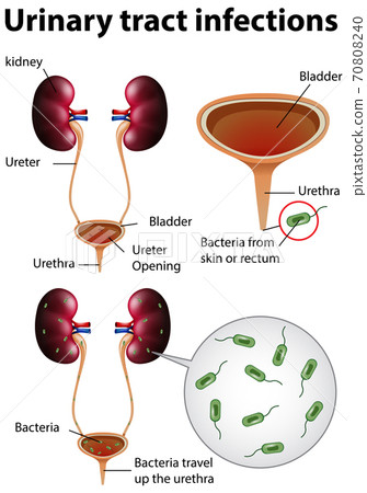 Informative illustration of urinary tract... - Stock Illustration ...