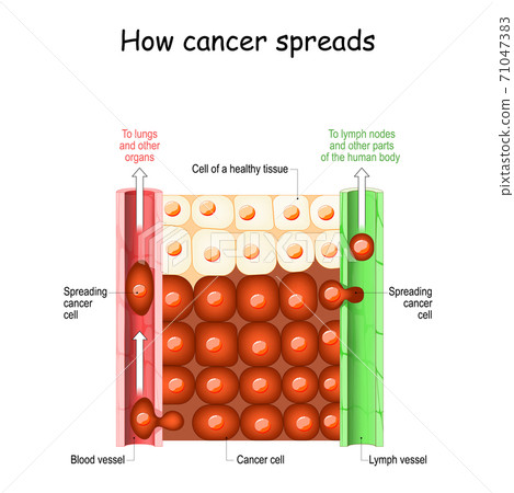 How cancer spreads. - Stock Illustration [71047383] - PIXTA