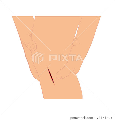 injured leg with bleeding gash with wound on... - Stock Illustration ...