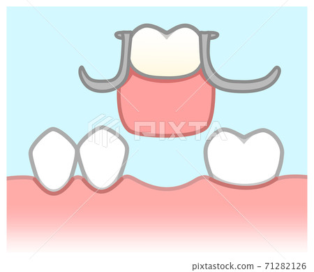 Illustrated partial denture - Stock Illustration [71282126] - PIXTA
