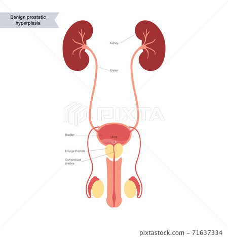 BPH info concept - Stock Illustration [71637334] - PIXTA