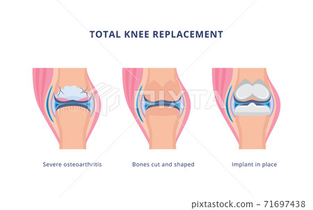 Total knee replacement surgery procedure, flat... - Stock Illustration ...