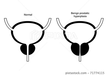BPH info concept - Stock Illustration [71774115] - PIXTA