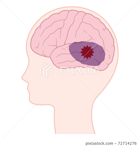 Illustration of cerebral infarction - Stock Illustration [72714276] - PIXTA