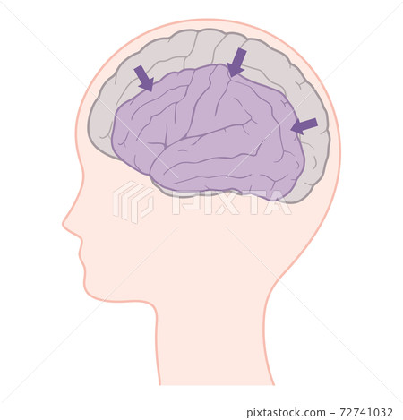 Brain Atrophy_Alzheimer's Dementia Brain... - Stock Illustration ...