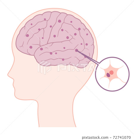 Illustration of brain and neurons in Lewy body... - Stock Illustration ...
