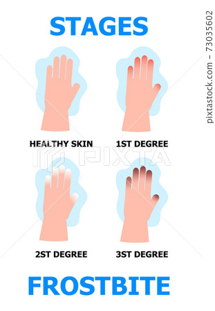 Frostbite stages info-graphic vector....-插圖素材 [73035602] - PIXTA圖庫