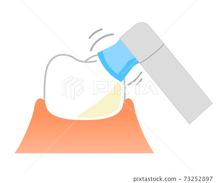 PMTC Teeth Cleaning: Dental Illustration - Stock Illustration [73252897 ...