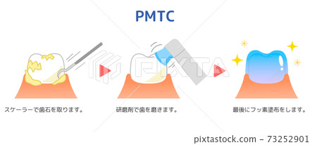 PMTC Teeth Cleaning: Dental Illustration - Stock Illustration [73252901 ...