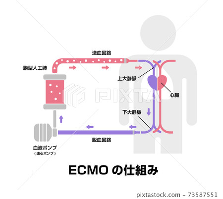 ECMO ・ Structure and mechanism of... - Stock Illustration [73587551 ...