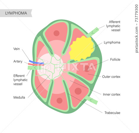 Lymphoma cancer concept - Stock Illustration [73779300] - PIXTA