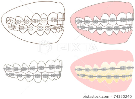 Metal bracket mounting set for orthodontic... - Stock Illustration ...