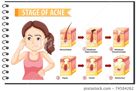 Stages of skin acne anatomy with a woman doing... - Stock Illustration ...
