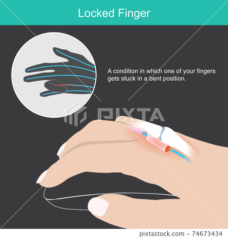 Locked Finger. This picture showing human of... - Stock Illustration ...