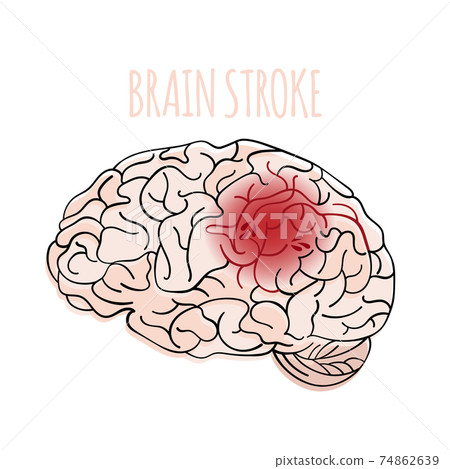 BRAIN STROKE Insult Apoplexy Medicine Health... - Stock Illustration ...