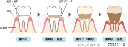 Periodontal disease process - Stock Illustration [75589448] - PIXTA