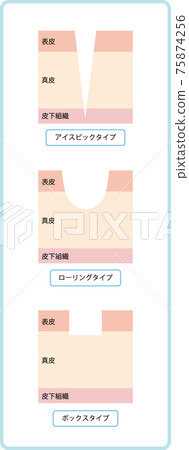 acne, skin, cross-section diagram - Stock Illustration [75874256] - PIXTA