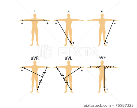 Einthoven ECG triangle, including augmented...-插圖素材 [76597322] - PIXTA圖庫