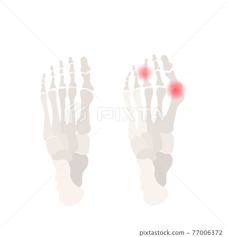 RHEUMATOID ARTHRITIS LEG Focal Lesions Of The... - Stock Illustration ...