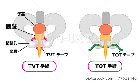 Urinary incontinence medical illustration... - Stock Illustration ...