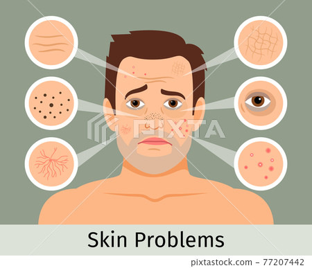 Male facial skin problems - Stock Illustration [77207442] - PIXTA