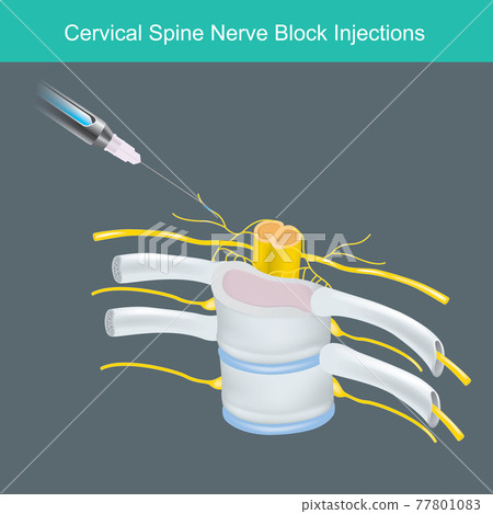 Cervical Spine Nerve Block Injections.... - Stock Illustration ...