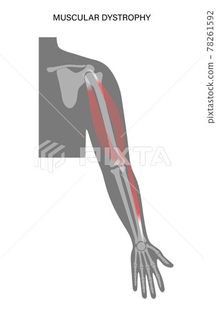 Muscular dystrophy of arm - Stock Illustration [78261592] - PIXTA