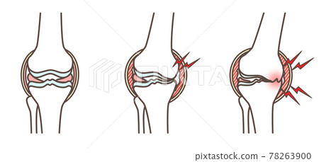 Illustration of knee osteoarthritis - Stock Illustration [78263900] - PIXTA