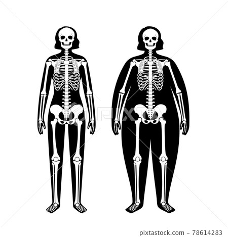 Obese skeleton anatomy - Stock Illustration [78614283] - PIXTA