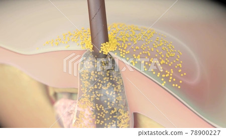 Acne And Pimples, Stages Of Development,... - Stock Illustration ...