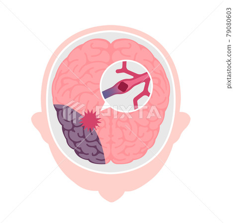 Causes and symptoms of cerebral infarction... - Stock Illustration ...