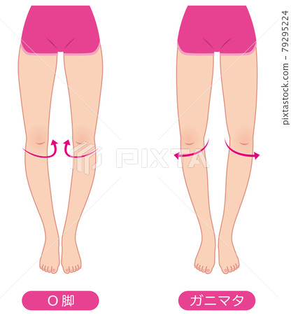 Leg distortion O leg crab crotch - Stock Illustration [79295224] - PIXTA